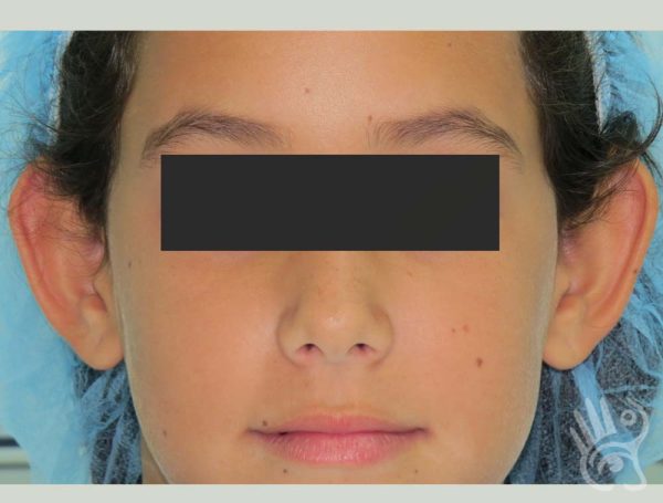 Ear Correction | Cosmetic Surgery Curacao | Dr. Karel Taams